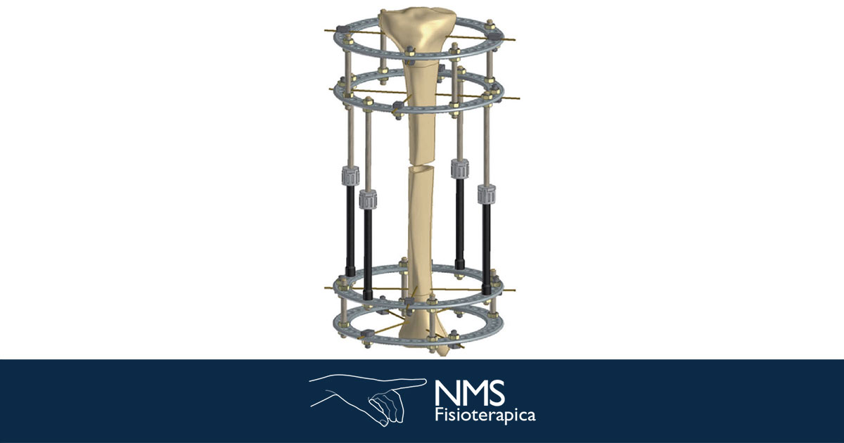 Il metodo Ilizarov - NMS Fisioterapica